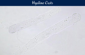 Hyaline Casts in Urine : Morphology And Clinical Significance