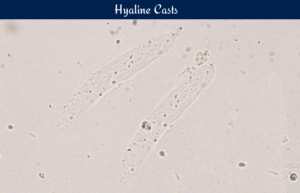 Hyaline Casts in Urine : Morphology And Clinical Significance