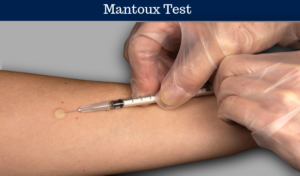 Mantoux Test : Principle, Procedure, Interpretation and Limitations